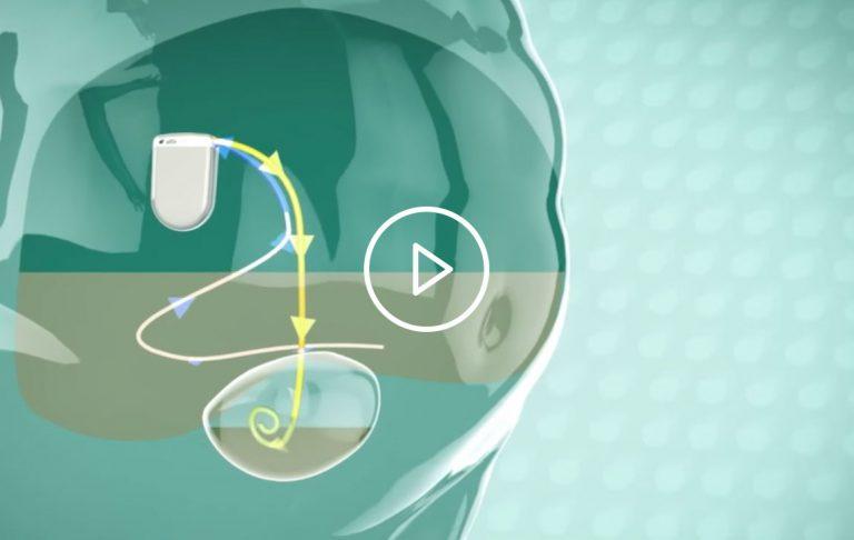 video-Direck_link - Alfapump